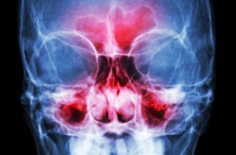 Chronic Sinusitis - Southern Utah Ear, Nose & Throat
